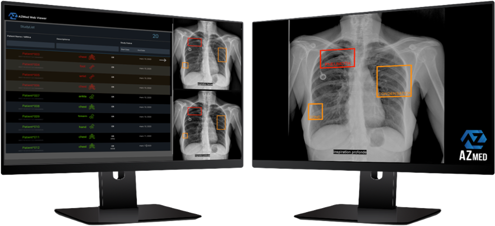 Automatic Chest X-ray Detection | Rayvolve for Trauma