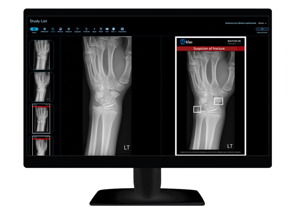 Automatic Fracture Detection | Rayvolve for Trauma