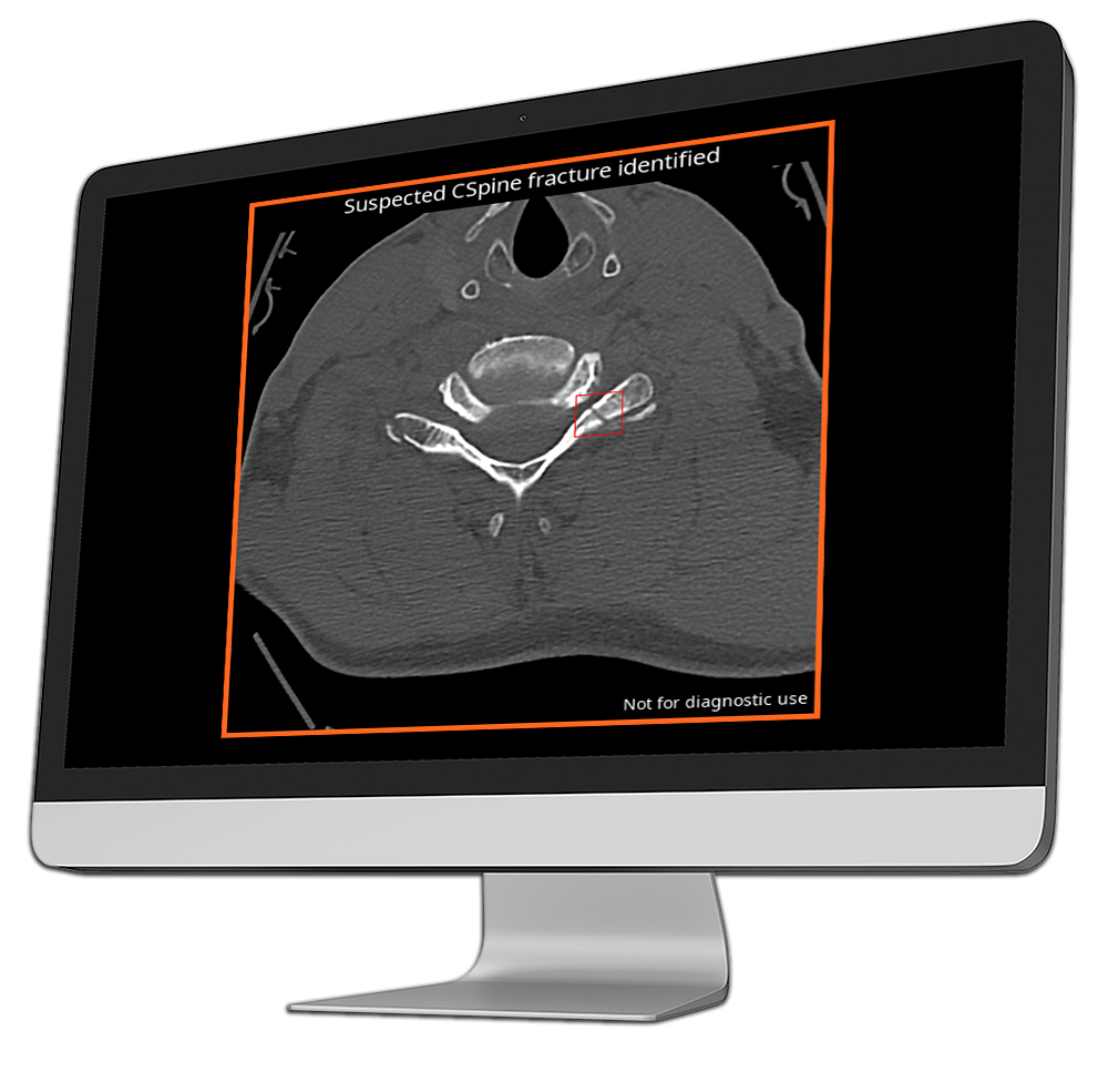 Detection of Cervical Spine Fractures | CINA CSpine