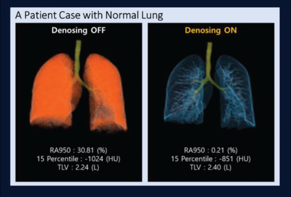 Advanced AI Solution for Lung CT Screenings | ClariPi ClariPulmo