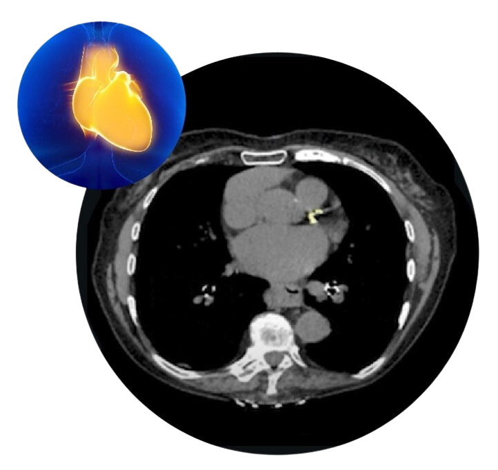 CAC detection | Nanox AI