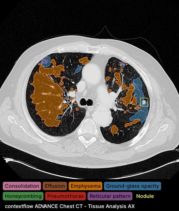 Lung Nodule Detection and Tracking | ADVANCE Chest CT