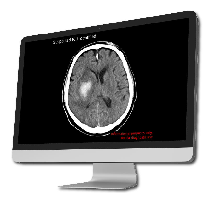 ICH Detection and Prioritization | CINA Head - ICH