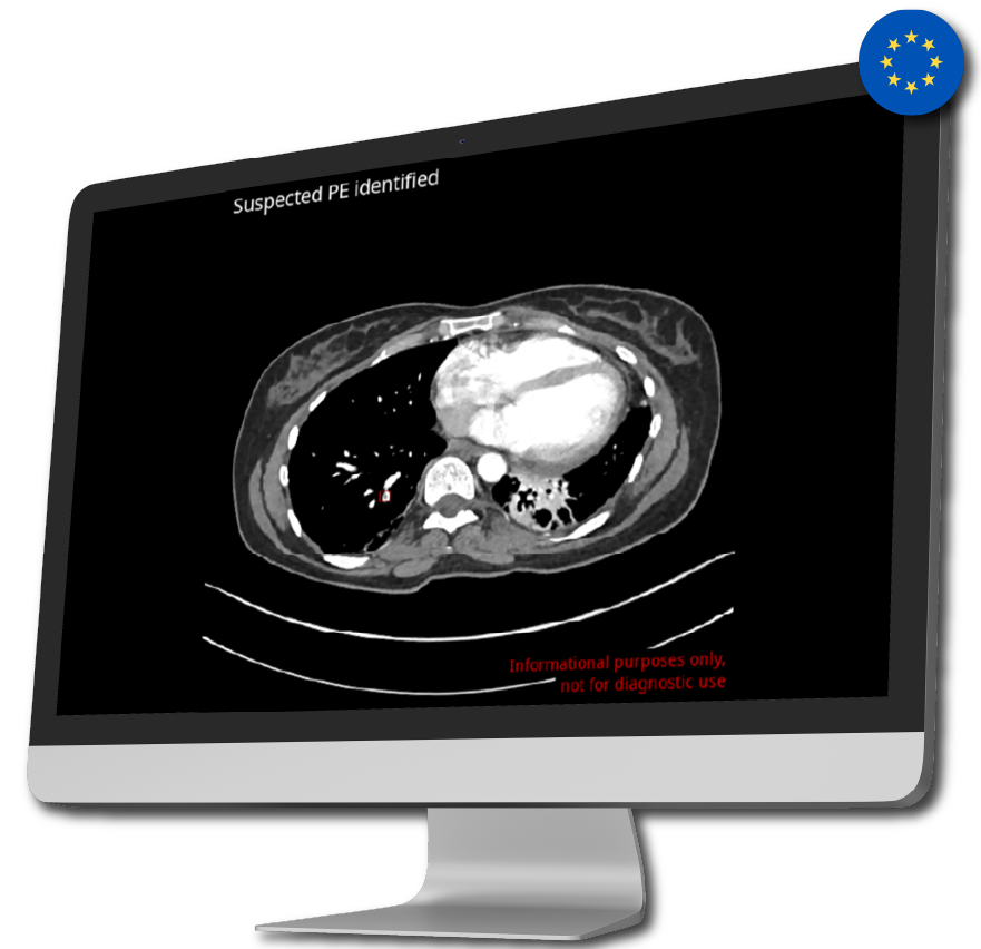 Incidental PE Detection | CINA Chest - iPE
