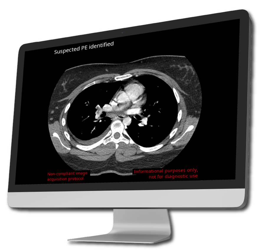 Pulmonary Embolism Detection | CINA Chest - PE