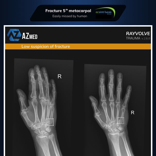 Automatic Fracture Detection | Rayvolve for Trauma