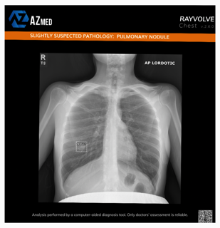 Automatic Chest X-ray Detection | Rayvolve for Trauma