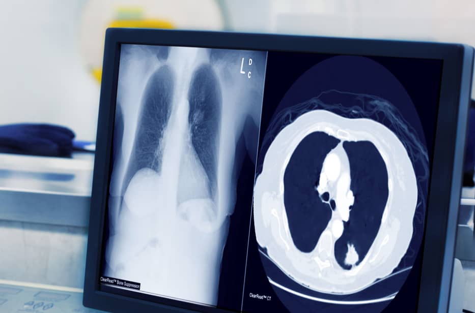 Chest CT and X-ray Interpretation | Riverain Technologies