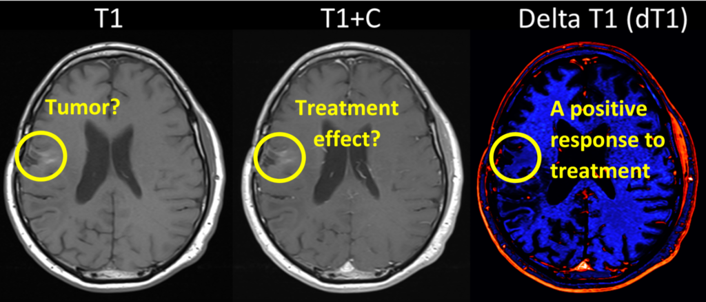 Comparison of T1 And T1+C Images | IB Delta T1 Maps