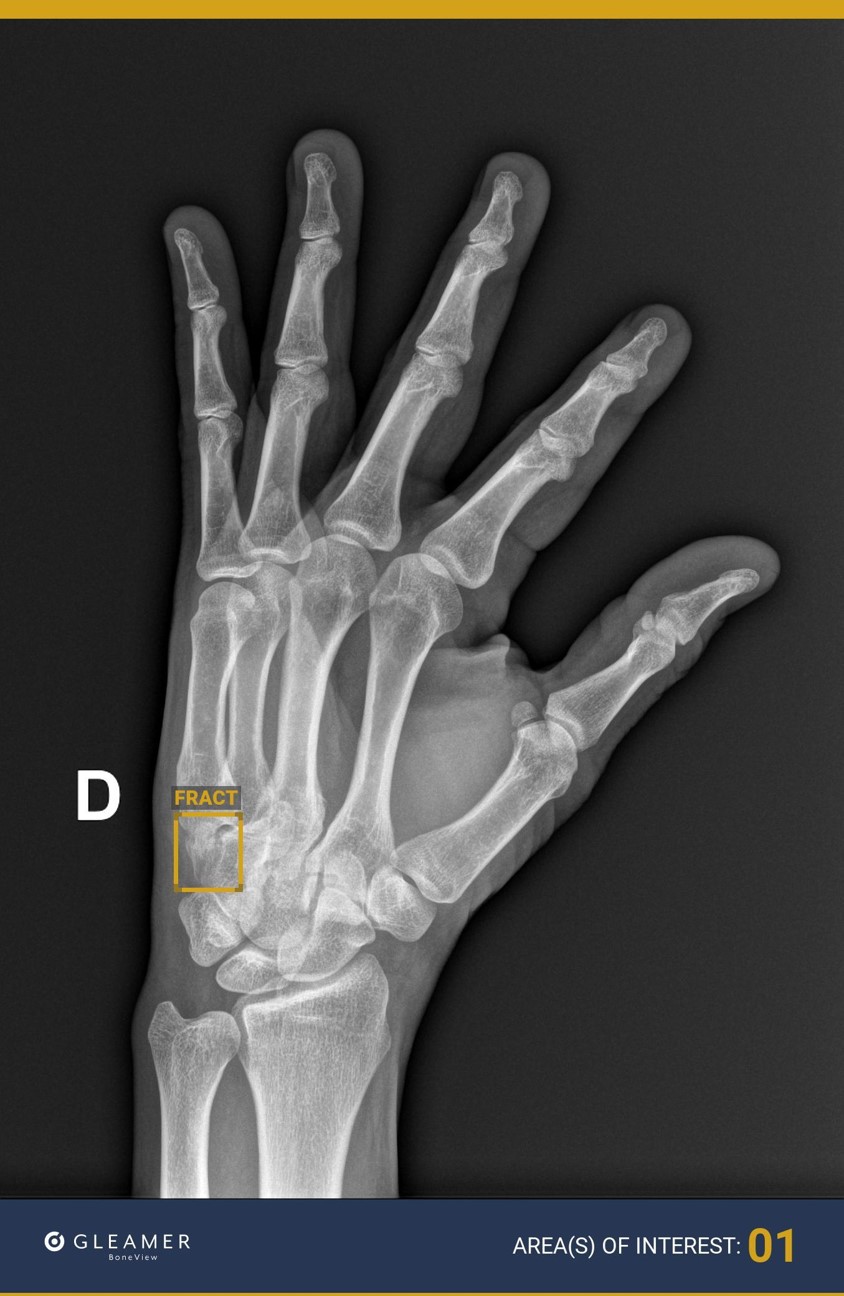 Fracture detection | BoneView