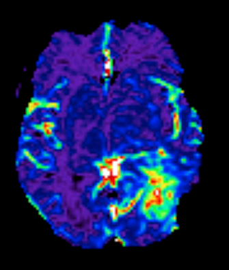 DSC Perfusion Processing | IB Neuro
