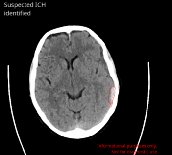 ICH Detection and Prioritization | CINA Head - ICH
