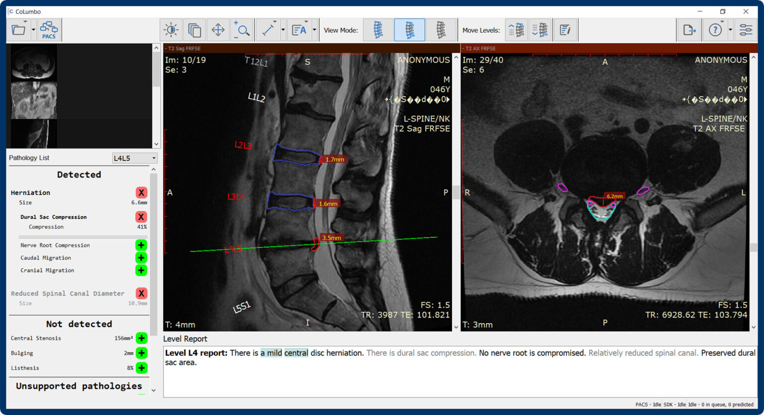 MRI Analysis Software for Lumbar Spine Images | SmartSoft CoLumbo