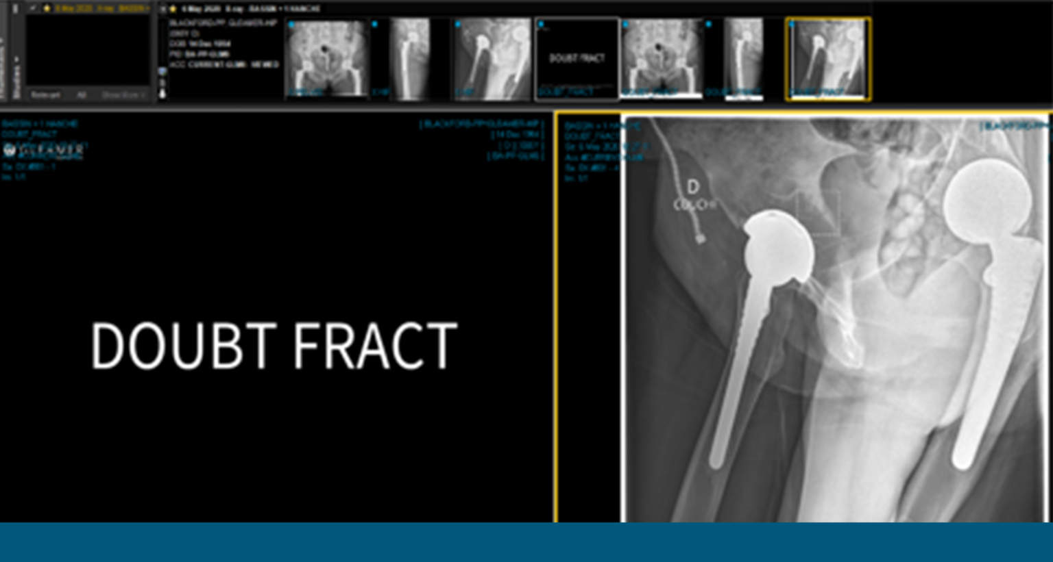 Improve Diagnostic Accuracy with Gleamer AI Solutions | BoneView ...