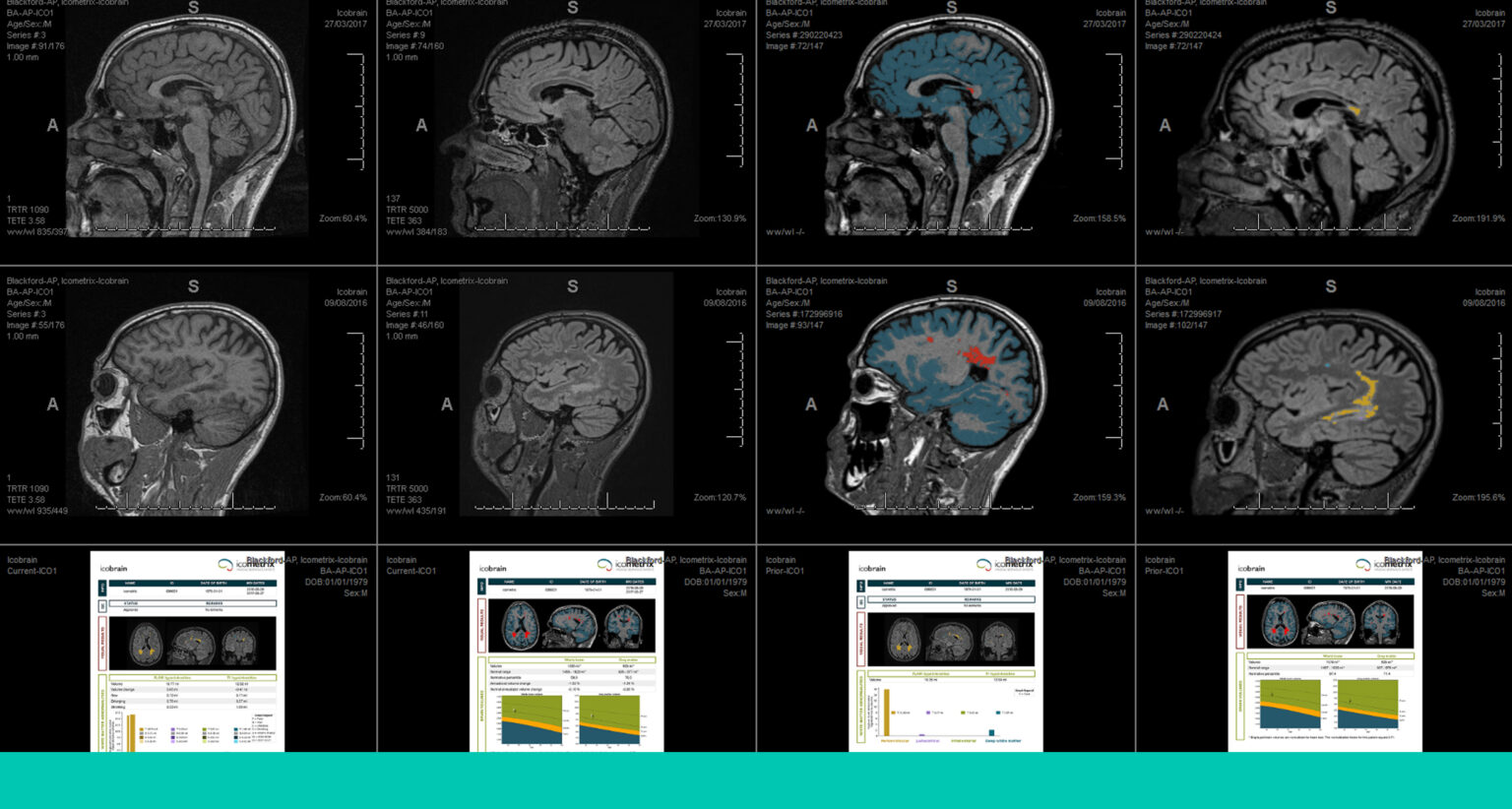 Early Prediction of Disability Progression in MS | icometrix icobrain