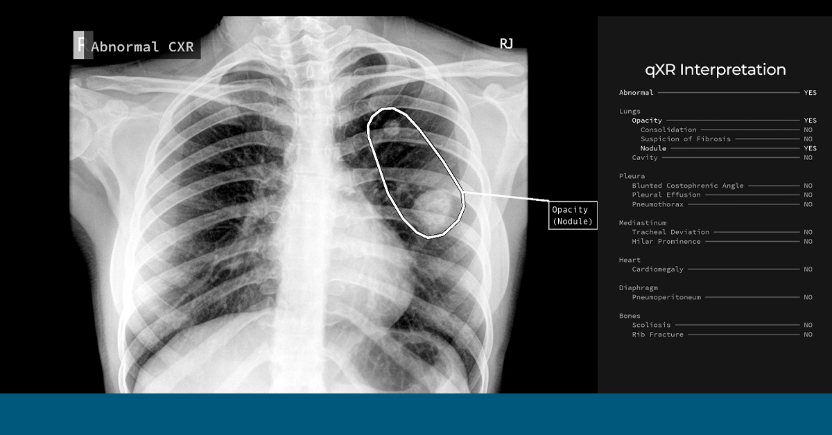 COVID and TB Detection | AI-Powered Solutions by Qure.ai