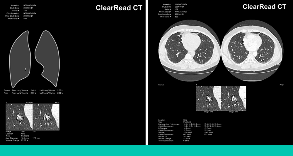 ClearRead CT and Xray Solutions for Lung Nodule Detection | Riverain
