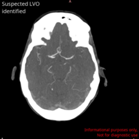 LVO Triage | CINA Head - LVO