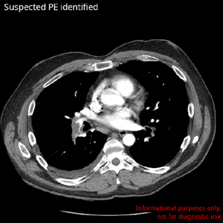 Pulmonary Embolism Detection | CINA Chest - PE
